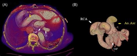 A CT Volume Rendering Reconstruction Axial View Showed Giant RCA And Download Scientific