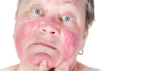 The Four Sensitive Skin Subtypes