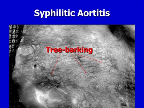 PPT Syphilis Clinical Aspects Of Late Syphilis PowerPoint Presentation ID 178603
