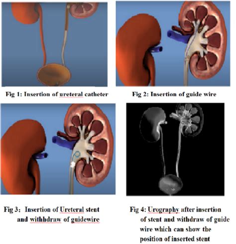 Ureteral Stent Insertion Procedure