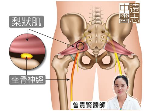 遠志中醫 《分析坐骨神經痛》 作者：曾貴賢醫師 59歲男patient，平時搬搬抬抬較多，腰部反反復復疼痛，一直未曾休息，近排因工作較為忙碌，加上搬重嘢較多，導致腰部疼痛加重，尤其下腰部