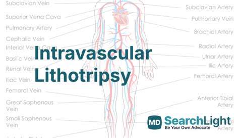 Intravascular Lithotripsy Shockwave Lithotripsy Md Searchlight