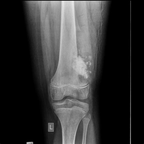 Tumeurs Os Ostéosarcome Pinkybone