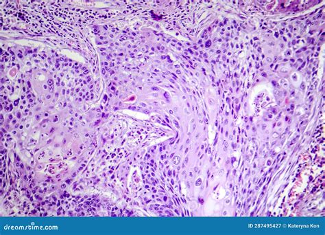 Squamous Cell Carcinoma Of The Lung Light Micrograph Stock Image