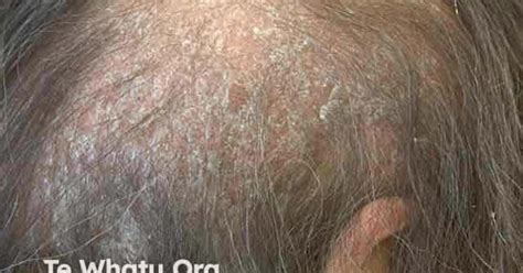 Scalp Psoriasis Image