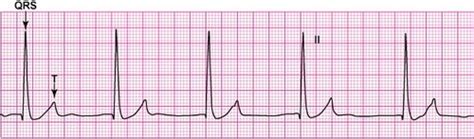 Ecg Rhythms Flashcards Quizlet