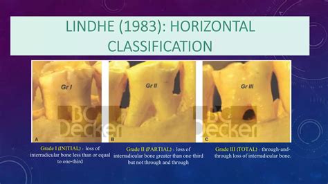 Furcation Involvement And Management Pptx