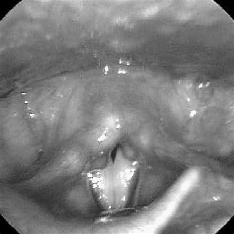 Posterior Glottic Chink With Paradoxical Vocal Fold Closure On Download Scientific Diagram