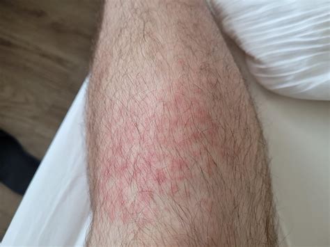Heat Rash On Legs Rdermatologyquestions