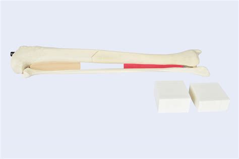 Tibia Right Fractured Nailed W Mid Diaphyseal Infection Intact Fibula A 2 Pc Soft Block