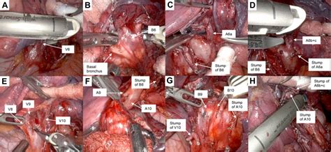 Robotic Left Superior And Posterior Basal S6s10 Segmentectomy Annals Of Thoracic Surgery