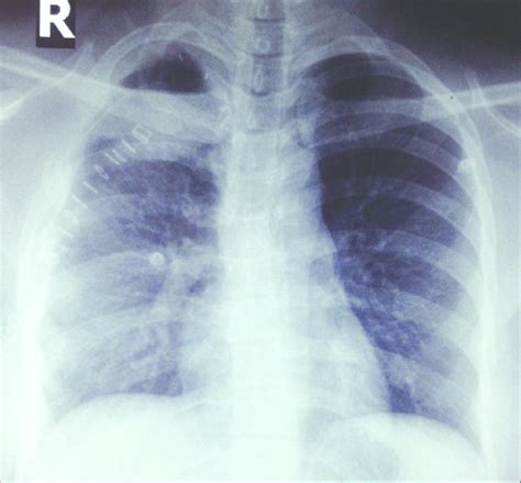 Post Operative Chest X Ray Showing Complete Excision Of The 3 Rd Rib