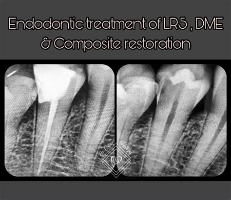 Omar Abd Elaziz On Linkedin Endodontics Dentistry Dentistryworld