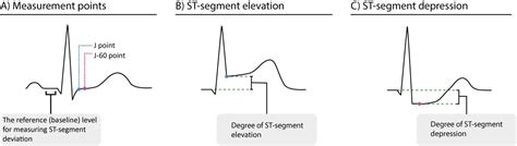 Figure 34 St Segment Deviation Ecg Learning Figure 34 St Segment Deviation Ecg Learning