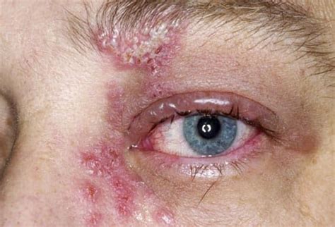 Shingles Rash Face