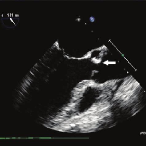 Two Dimensional Echo Showing Vegetation On Bicuspid Aortic Valve Arrow
