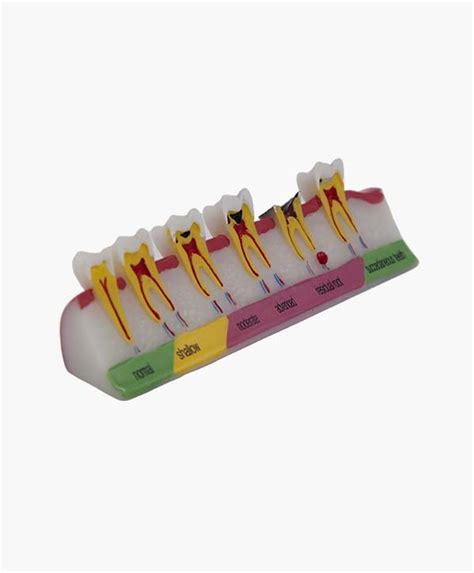 Tooth Decay Classification Model Feiman