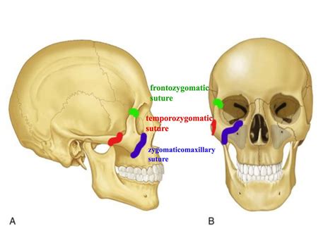 Zygoma Anatomy Zygoma Fracture Zygoma Surgery 58 Off