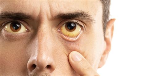 Understanding Hepatitis E Causes Symptoms Treatment And Prevention