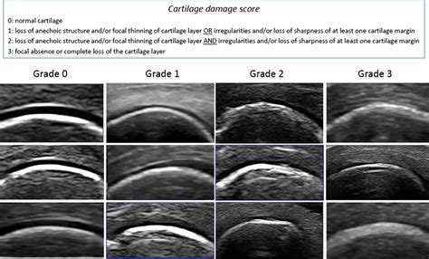 Global Ultrasound Assessment Of Structural Lesions In Osteoarthritis A