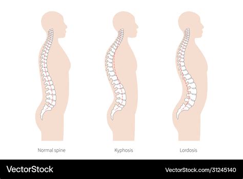 Kyphosis Lordosis Flat Royalty Free Vector Image
