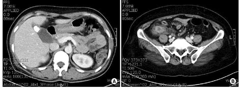 Figure 1 From Single Incision Laparoscopic Surgery For Simultaneous