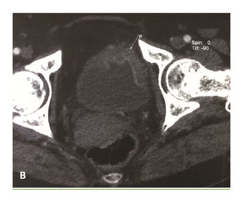 Preoperative Imaging Of The Bladder Lesion A Ultrasonography Showing Download Scientific