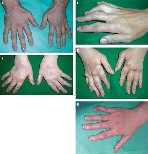Sintetiza 56 Imágenes Sobre Por Que Se Deforman Las Uñas De Las Manos Recién Actualizado