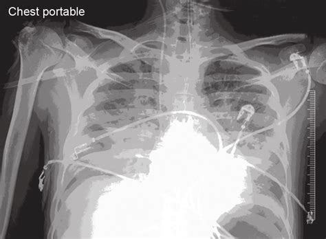 X Ray Chest Of Patient On Day 2 Of Intensive Care Unit Icu Admission