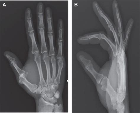 Metacarpophalangeal Joint Dislocation