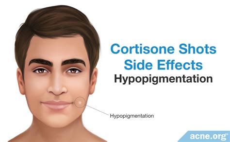 Cortisone Injection Zit At Matilda Chomley Blog