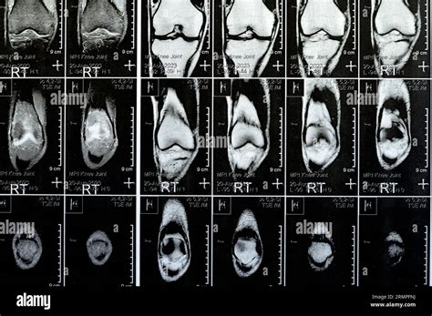 Mri Of The Right Knee Showing Mild Joint Effusion With Normal Other