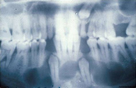 Dentigerous Cyst Definition Clinical Features Types Radiographic Features Treatment
