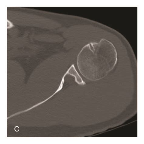 A Surgery For The Intraosseous Ganglion Is Performed In The Right Download Scientific Diagram
