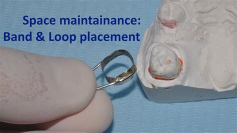 Band And Loop Placement Athanasios Nasiopoulos Thessaloniki Edinburgh