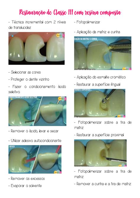 Restauração De Classe Iii Técnica De Resina Composta E