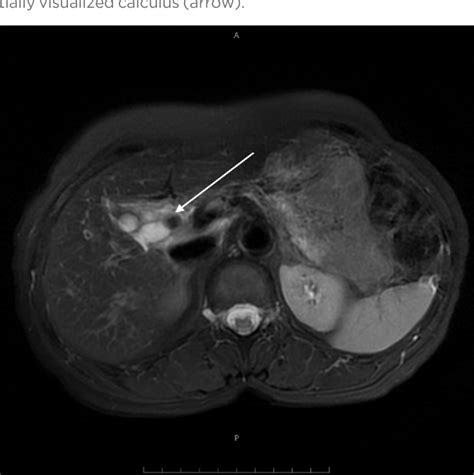 Fossa For Gallbladder Semantic Scholar