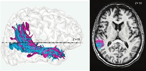Anterior Posterior Variability Of The Right Superior Temporal Sulcus