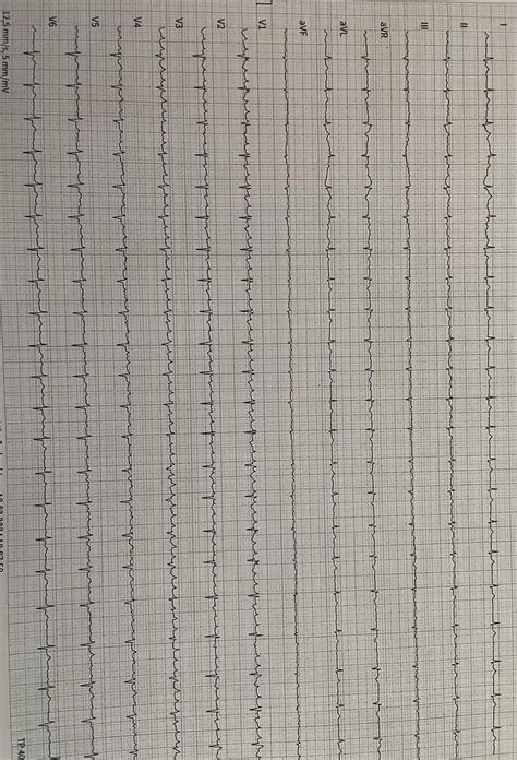 Atrial Flutter Or Av Block Iii R Ekg