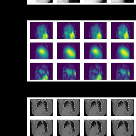 Respiratory Motion Estimation And Volumetric Imaging For Patient 1 A Download Scientific
