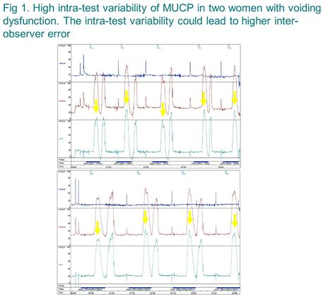 Ics 2020 Abstract 91 Urethral Pressure Profile In Women With Voiding Dysfunction