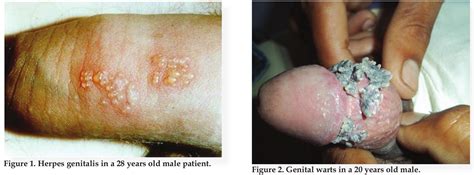 Herpes Genitalis In A 28 Years Old Male Patient Figure 2