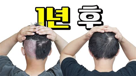 비절개모발이식 20대남성 헤어라인 모발이식 후 1년 경과 전후사진 동영상 리얼후기 Youtube