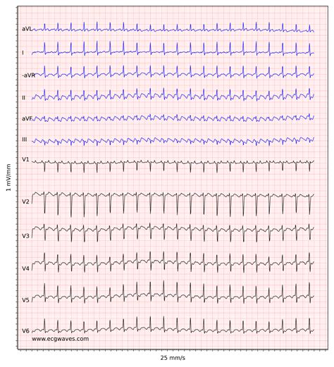 Atrial Flutter Classification Causes Ecg Diagnosis And Management