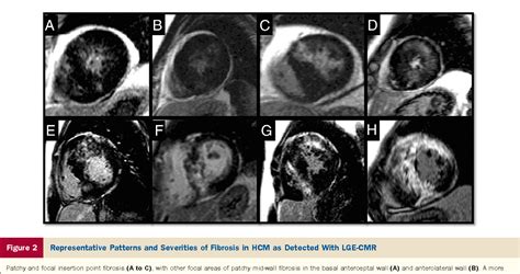 Sustained Ventricular Tachycardia Semantic Scholar