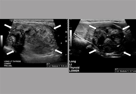Thyroid Nodule Ultrasound