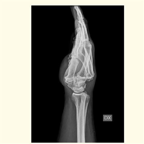 B Lateral View Of The Hand Showing Dorsal Dislocation Of Four Ulnar