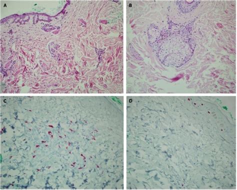 Diffuse Melanosis Cutis As The First Sign Of Recurrence Of Low Risk