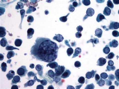 Significance Of Polyomavirus Detection In Urine Cytology An Update