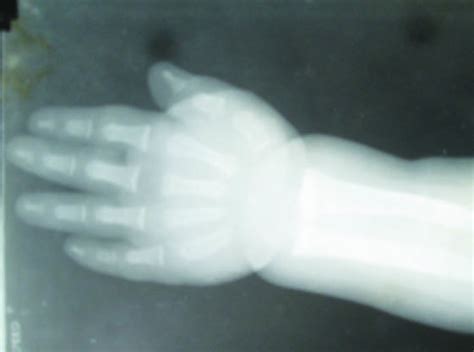 Primary Hypothyroid And Secondary Adrenal Insufficiency Searching The